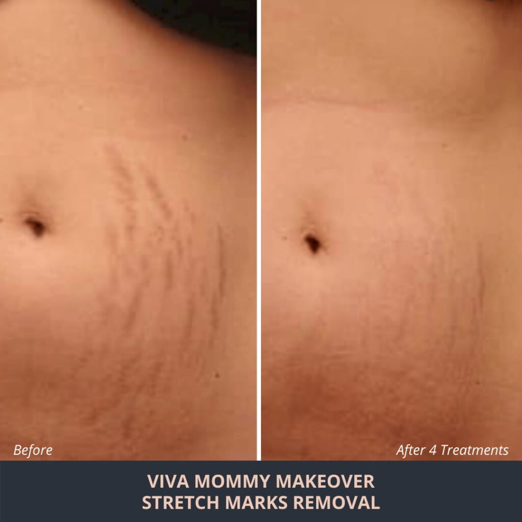 Microneedling Rf Radio Frequency Microneedling Novuskin