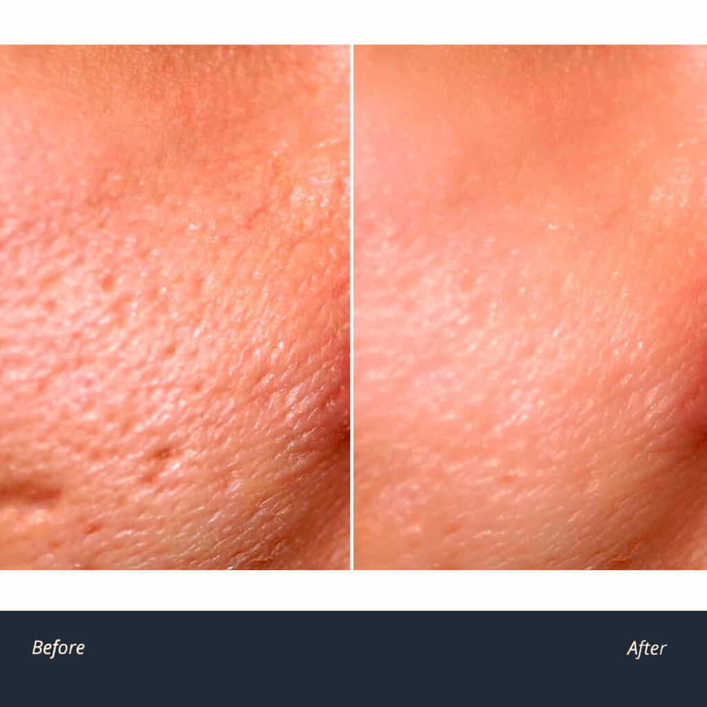 Blackheads and Clogged Pores Treatment for Face | Novuskin