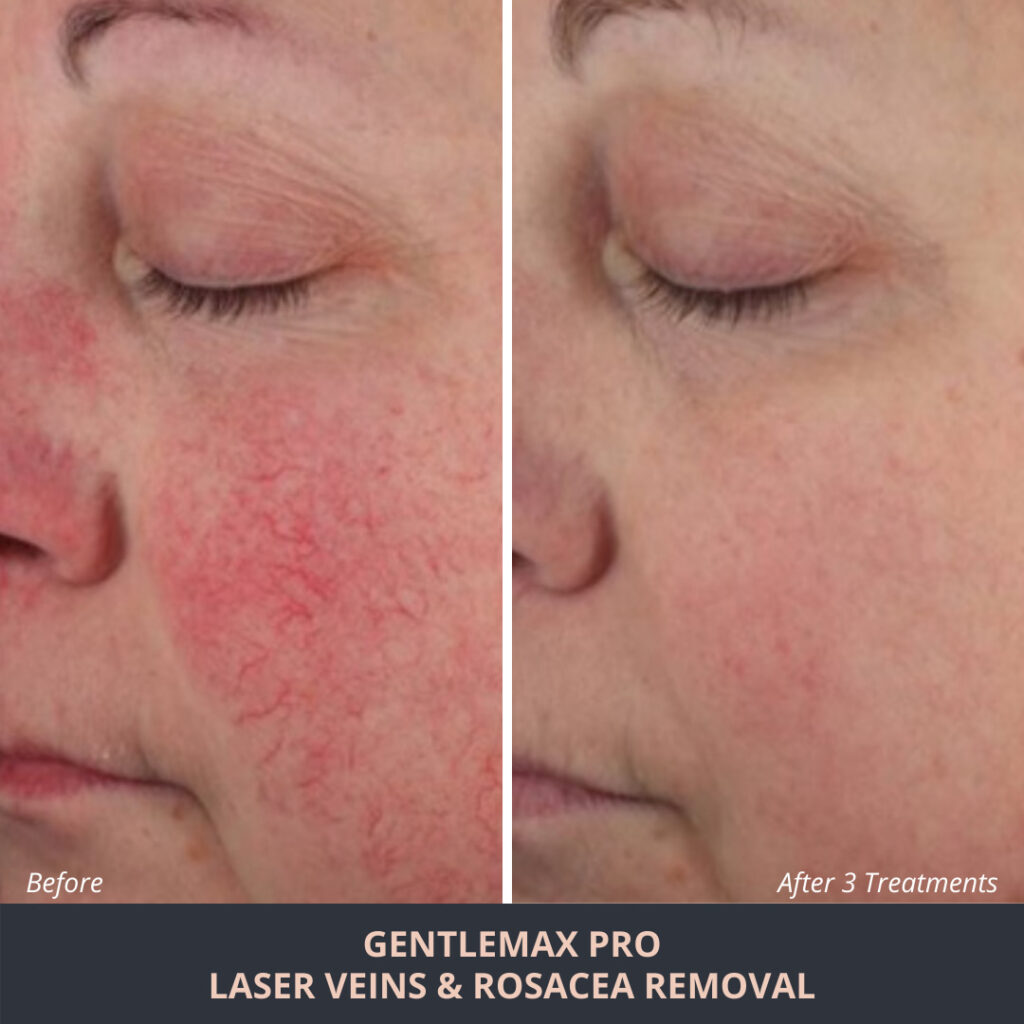 Gentle Max Pro - Novuskin