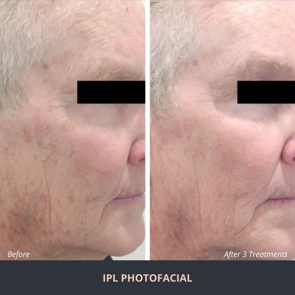 IPL Photofacial - Novuskin