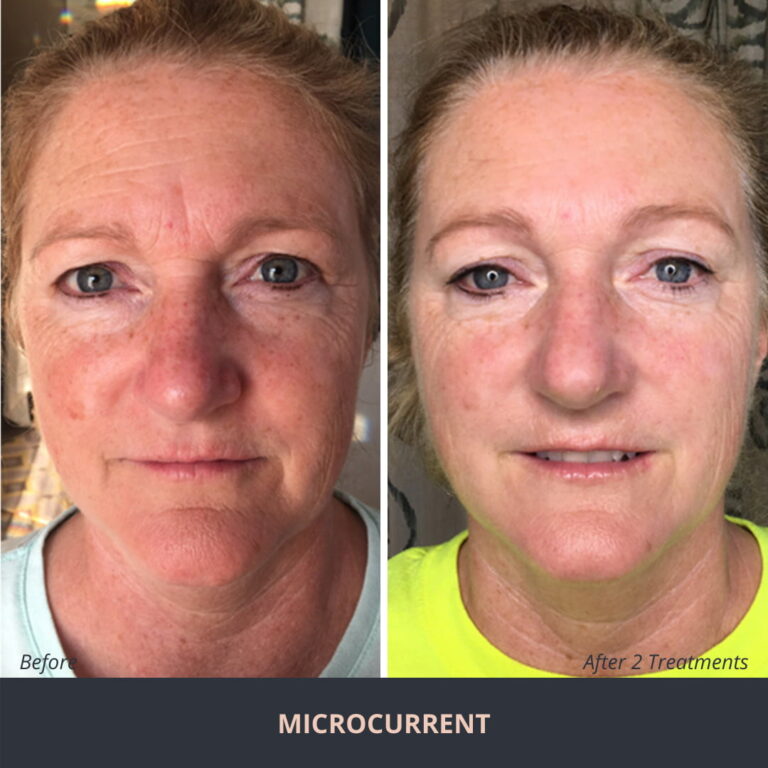 Microcurrent non surgical facelift - Novuskin