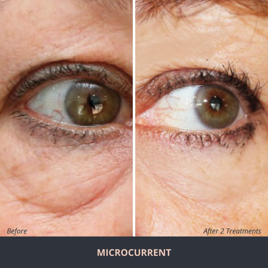 Microcurrent non surgical facelift - Novuskin