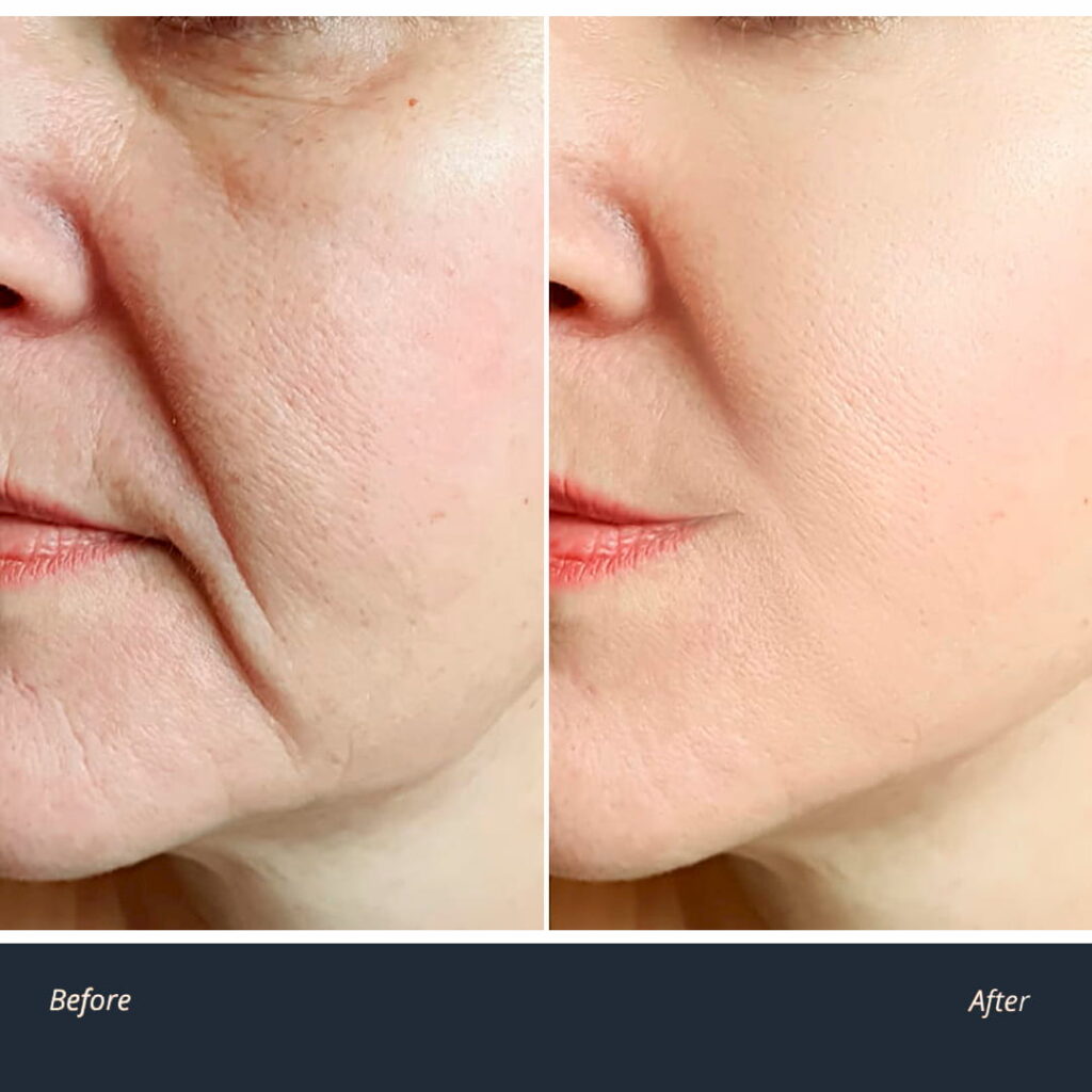 Crepey skin treatments: help reduce loose skin on face and neck | Novuskin