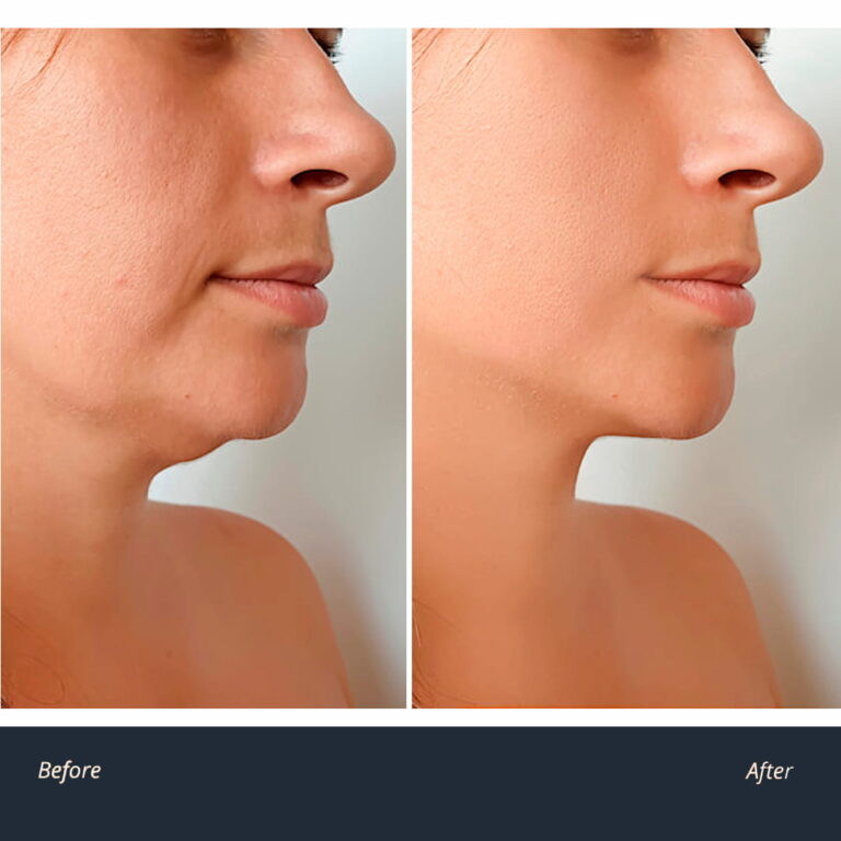 Turkey Neck Treatment & Non-Surgical Neck Lift Options