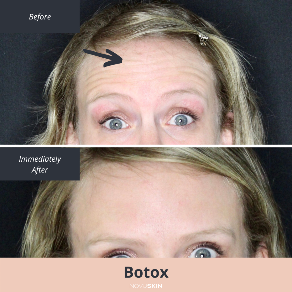 Dermal Fillers And Neuromodulators Novuskin