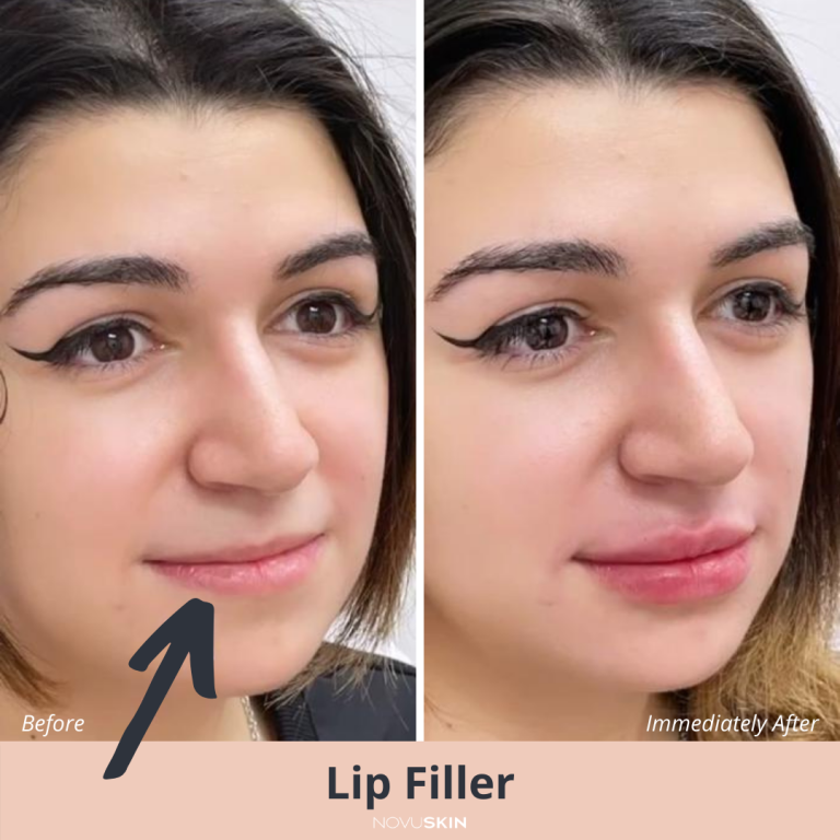 Dermal Fillers And Neuromodulators Novuskin