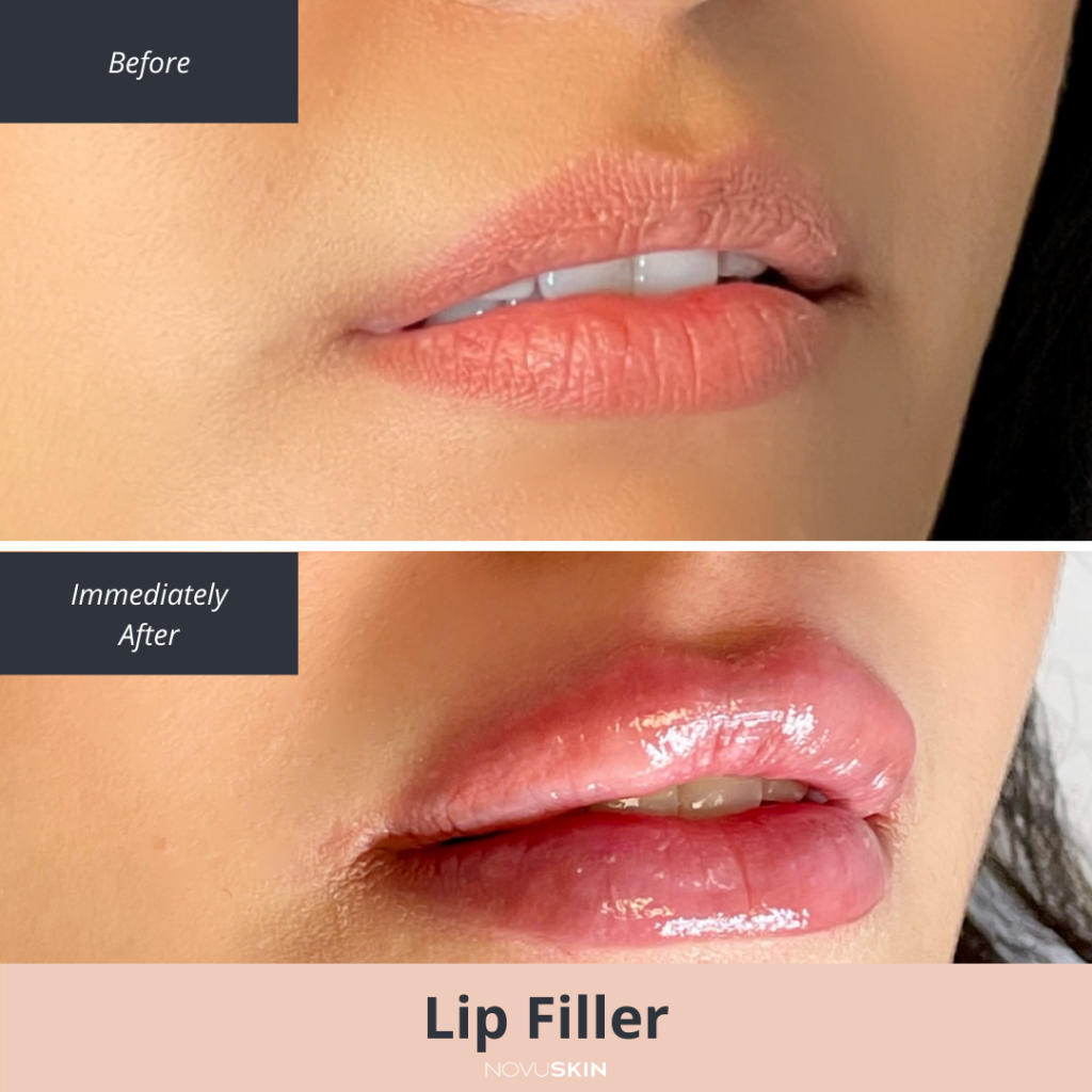 Dermal Fillers And Neuromodulators Novuskin