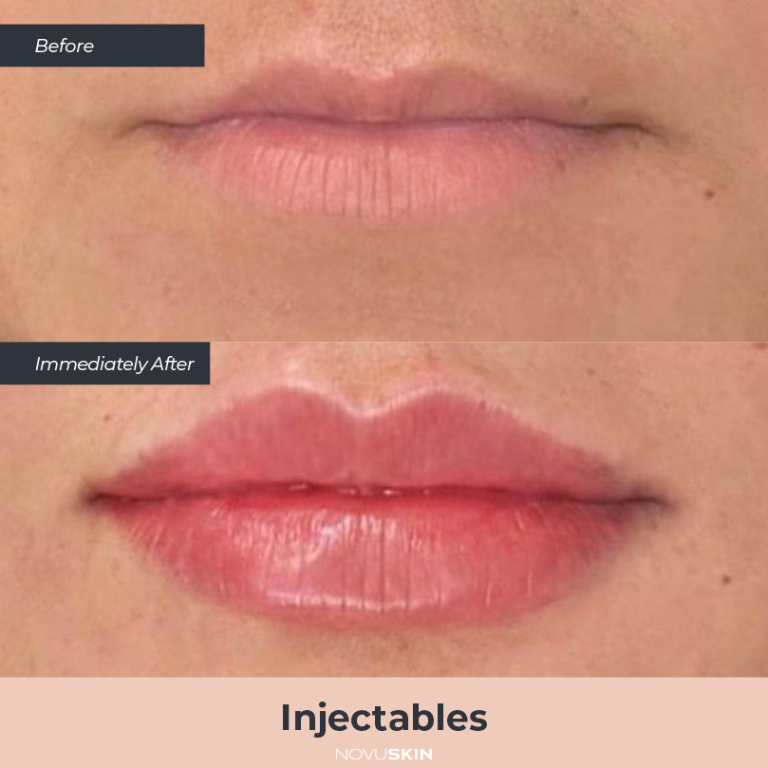 Dermal Fillers And Neuromodulators Novuskin