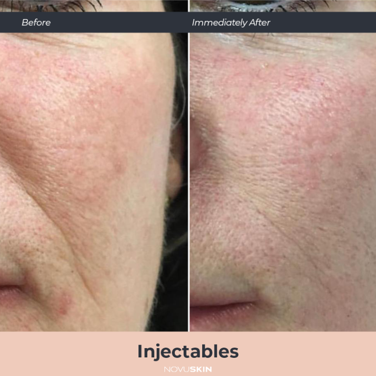 Dermal Fillers And Neuromodulators Novuskin