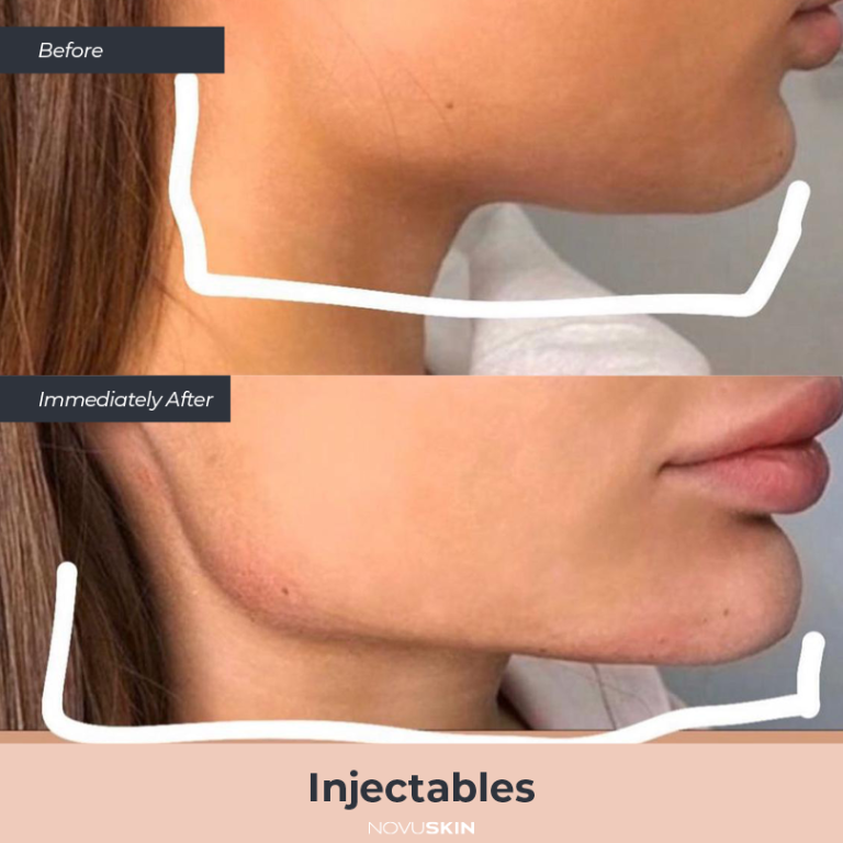 Dermal Fillers And Neuromodulators Novuskin