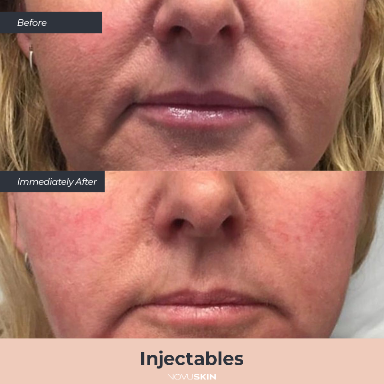 Dermal Fillers And Neuromodulators Novuskin