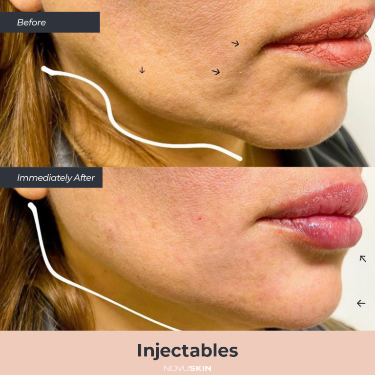 Dermal Fillers And Neuromodulators Novuskin