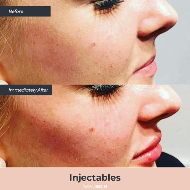 Dermal Fillers And Neuromodulators Novuskin