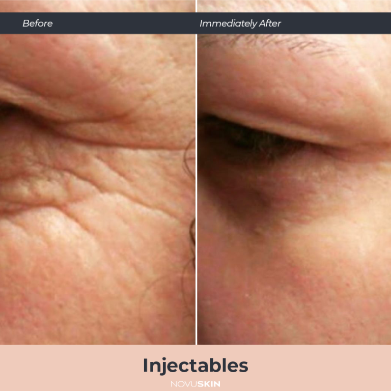 Dermal Fillers And Neuromodulators Novuskin