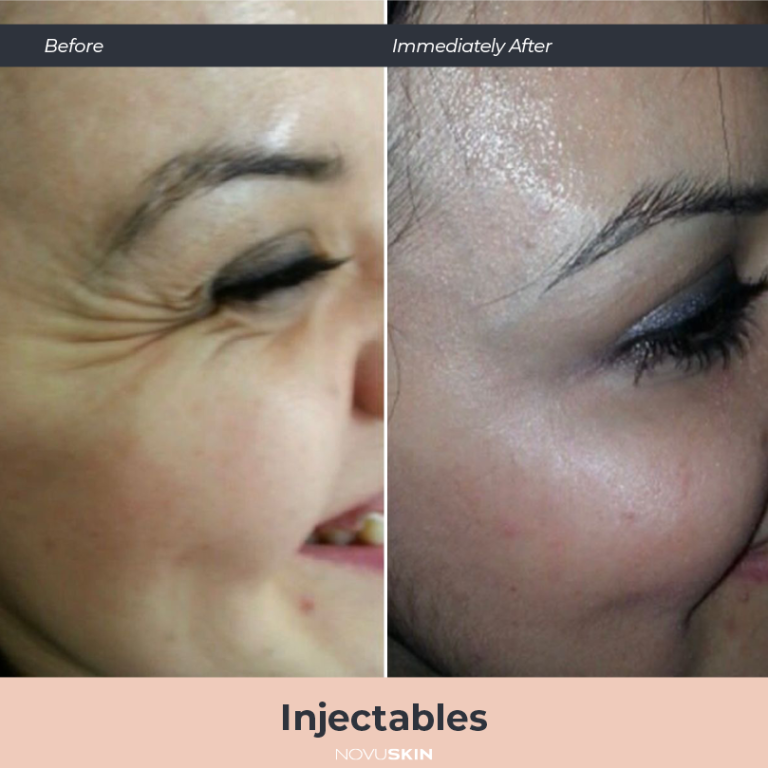 Dermal Fillers And Neuromodulators Novuskin